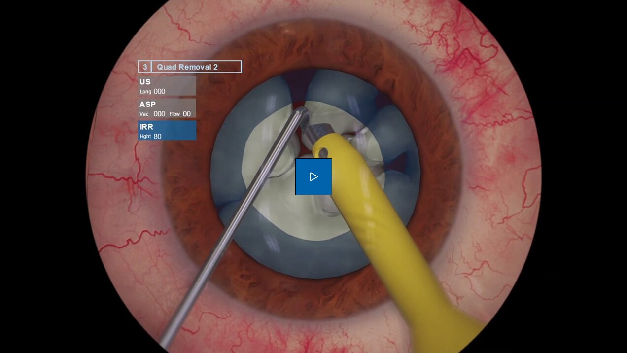 Eyesi Surgical software release 4.0
